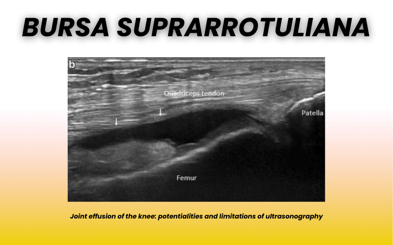 Ecografía y patología de la rodilla | Tempo Formación