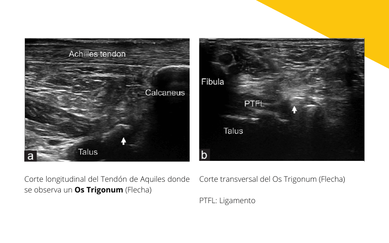 Os Trigonum Ecografía | Tempo Formación