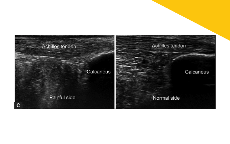 Os Trigonum Ecografía | Tempo Formación