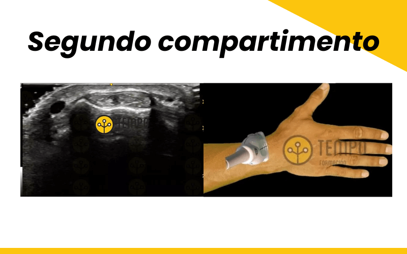 Compartimentos de la muñeca y Ecografía | Tempo Formación