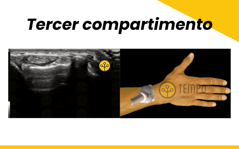 Compartimentos de la muñeca y Ecografía | Tempo Formación