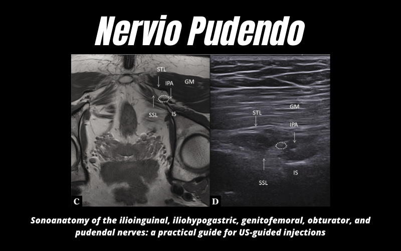 Nervio Obturador, Nervio Pudendo, Nervio Ilioinguinal, Nervio ...