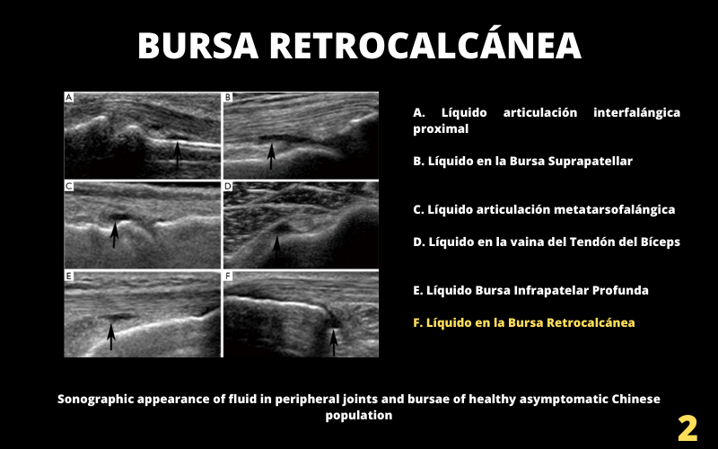 Bursas y Ecografía - Parte 2 Tobillo y Pie | Tempo Formación