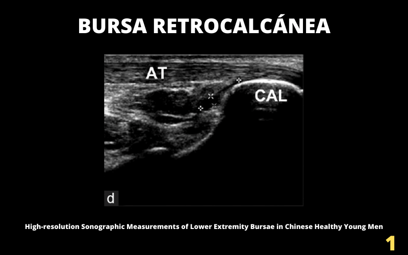 Bursas y Ecografía - Parte 2 Tobillo y Pie | Tempo Formación