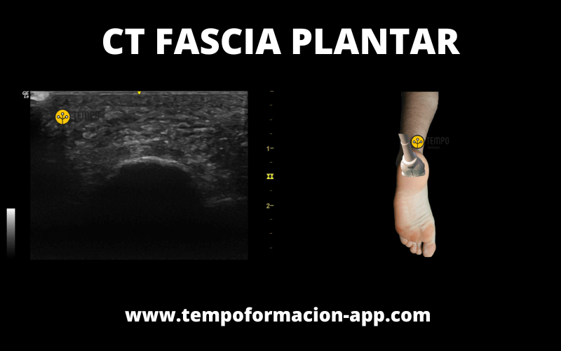 Fascia Plantar Ecografía - Aprende a valorarla | Tempo Formación