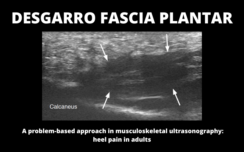 Fascia Plantar Ecografía - Aprende a valorarla | Tempo Formación