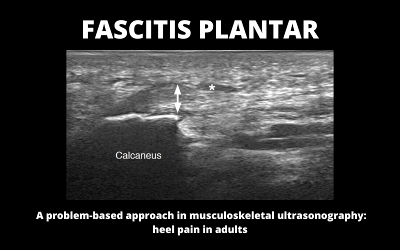 Fascia Plantar Ecografía - Aprende a valorarla | Tempo Formación