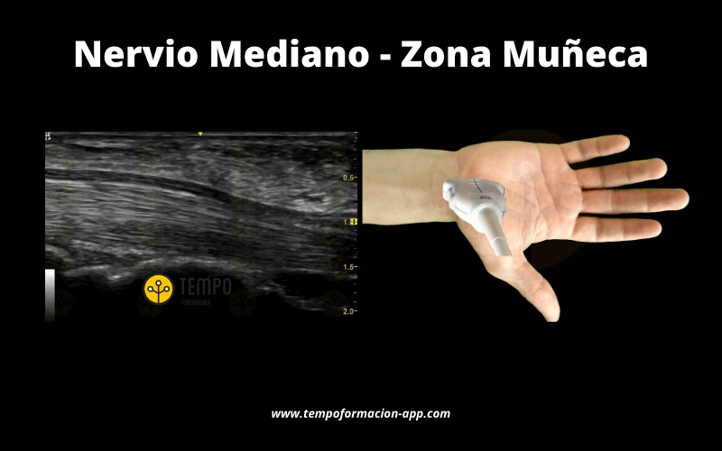 Lesión Del Nervio Mediano Mano