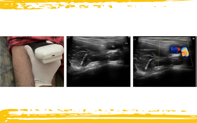 Músculo pectíneo y ecografía | Tempo Formación