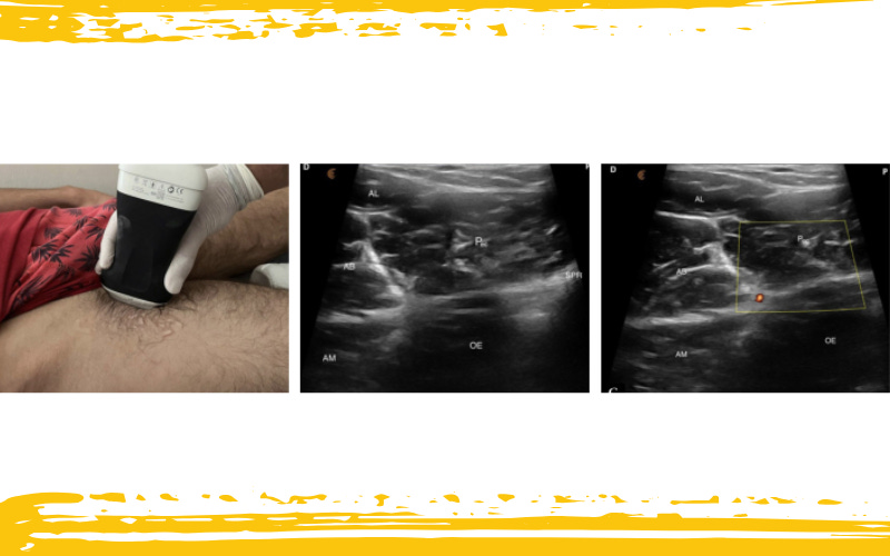 Músculo pectíneo y ecografía | Tempo Formación
