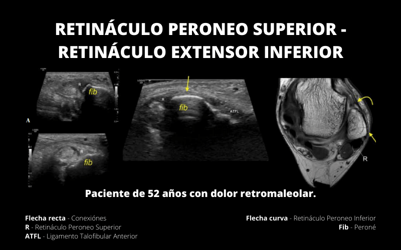 Retináculo Peroneo - Variantes anatómicas | Tempo Formación