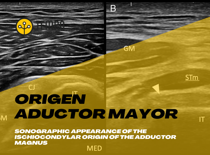 Tendón aductor mayor y ecografía | Tempo Formación