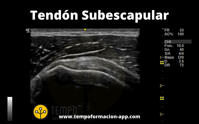 Manguito Rotador y Ecografía | Tempo Formación